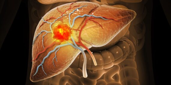 Understanding Liver Cancer Stages with Dr. Manoj Dongare